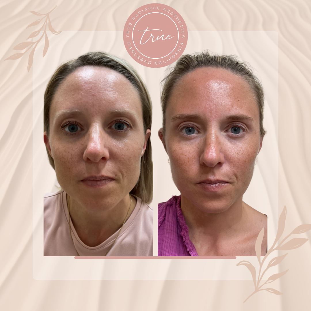 Masseter Botox: Redefine Your Jawline and Ease TMJ Pain ...